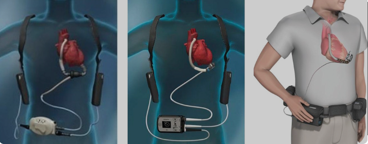 Cardiovascular : Ventricular Assist Devices - Pea Ridge EMS Training